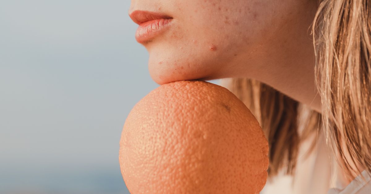 Can cryotherapy help with acne? - Recovery Clinic